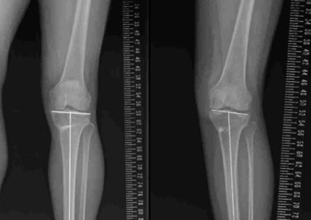 Double level osteotomy（DLO） | 高位脛骨骨切り術｜膝周囲骨切り術｜膝骨壊死｜ふれあい横浜