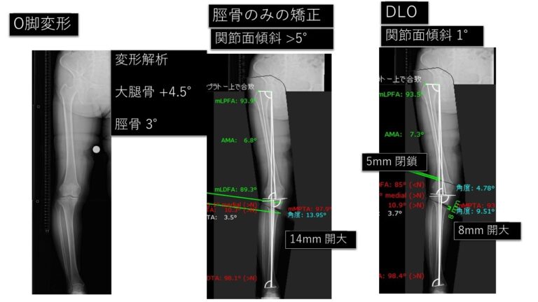 Double Level Osteotomy Dlo 高位脛骨骨切り術｜膝周囲骨切り術｜膝骨壊死｜ふれあい横浜